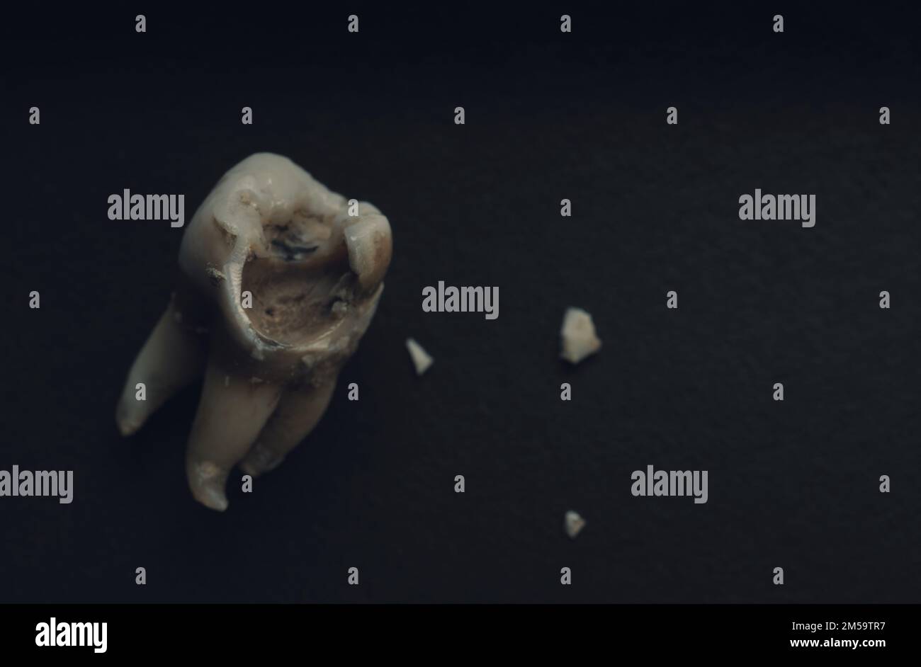 Tooth decay on black background. Macro shot of a decayed teeth till ...