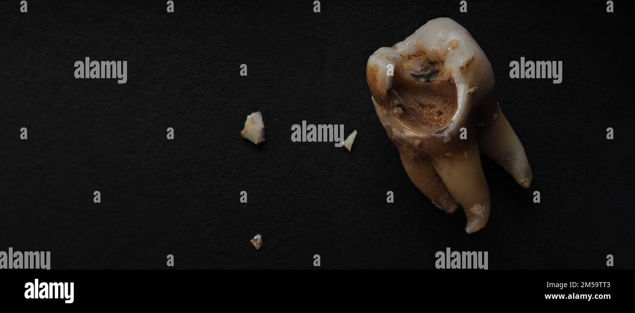 Tooth decay on black background. Macro shot of a decayed teeth till ...