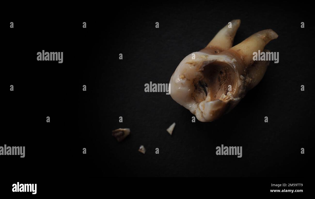 Decay root canel hi-res stock photography and images - Alamy