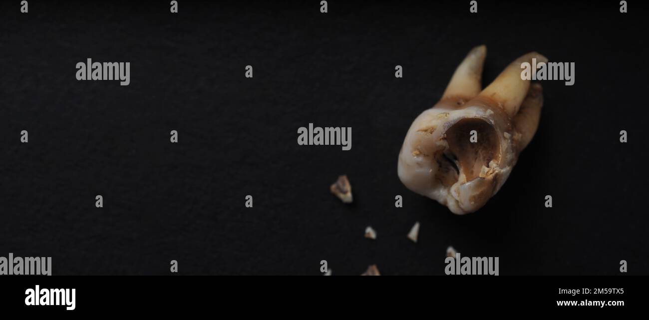 Tooth decay on black background. Macro shot of a decayed teeth till ...
