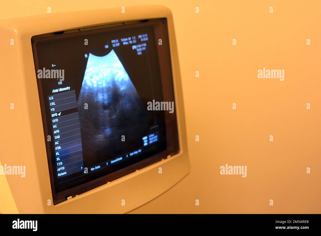 Ultrasonography on the uterus of a pregnant woman showing a healthy ...