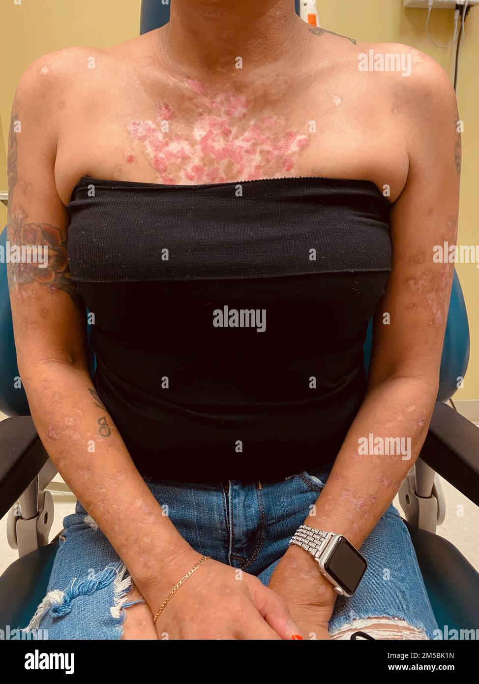 Editorial use only Severe scarring on the chest of a 48 year old ...