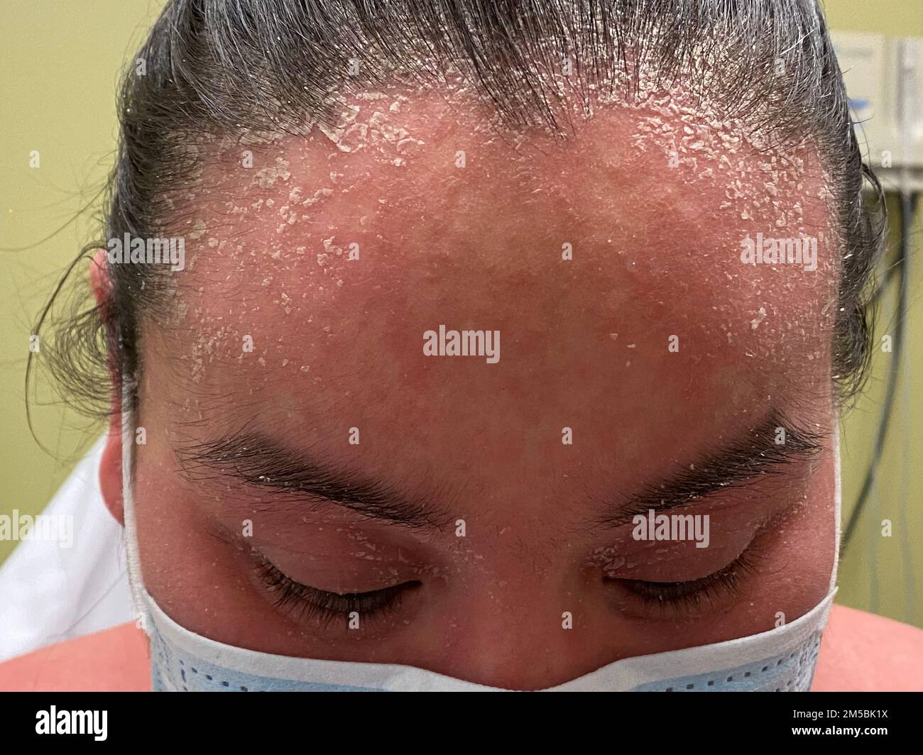 Editorial use only Erythrodermic psoriasis on the face and scalp of a ...