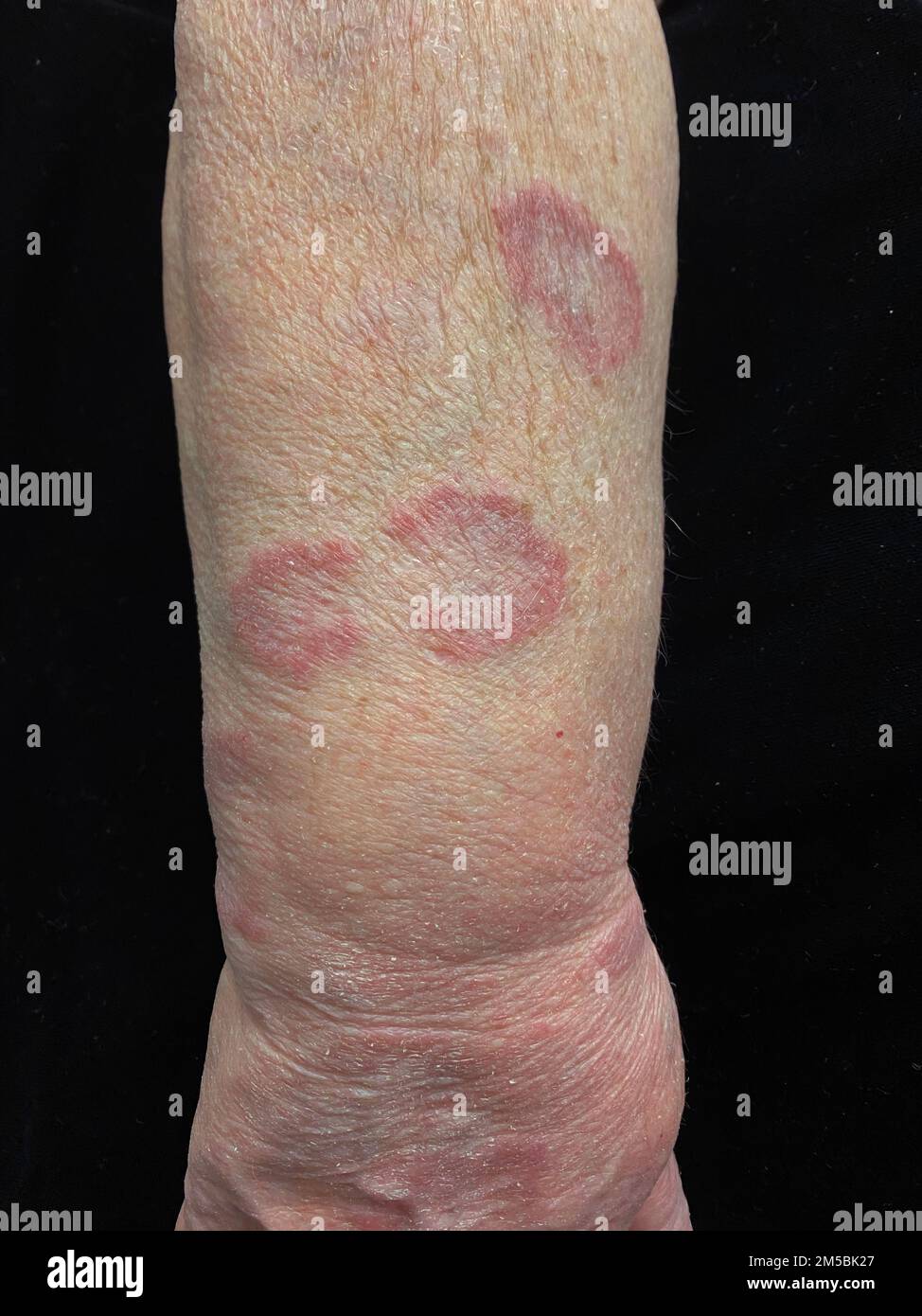 Not to be used for advertising or in a defamatory context Granuloma ...