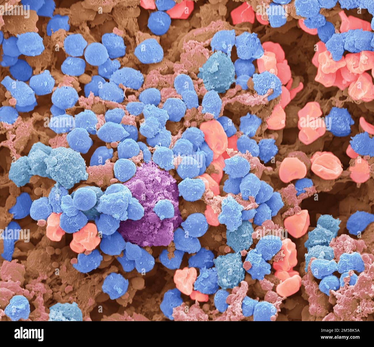 Lymphoma. Coloured scanning electron micrograph (SEM). Hodgkin lymphoma ...