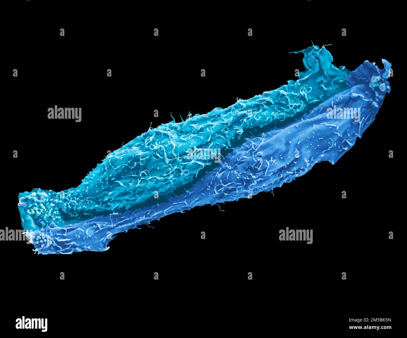 Images not to be used by the tobacco industry. Skin cancer cells ...