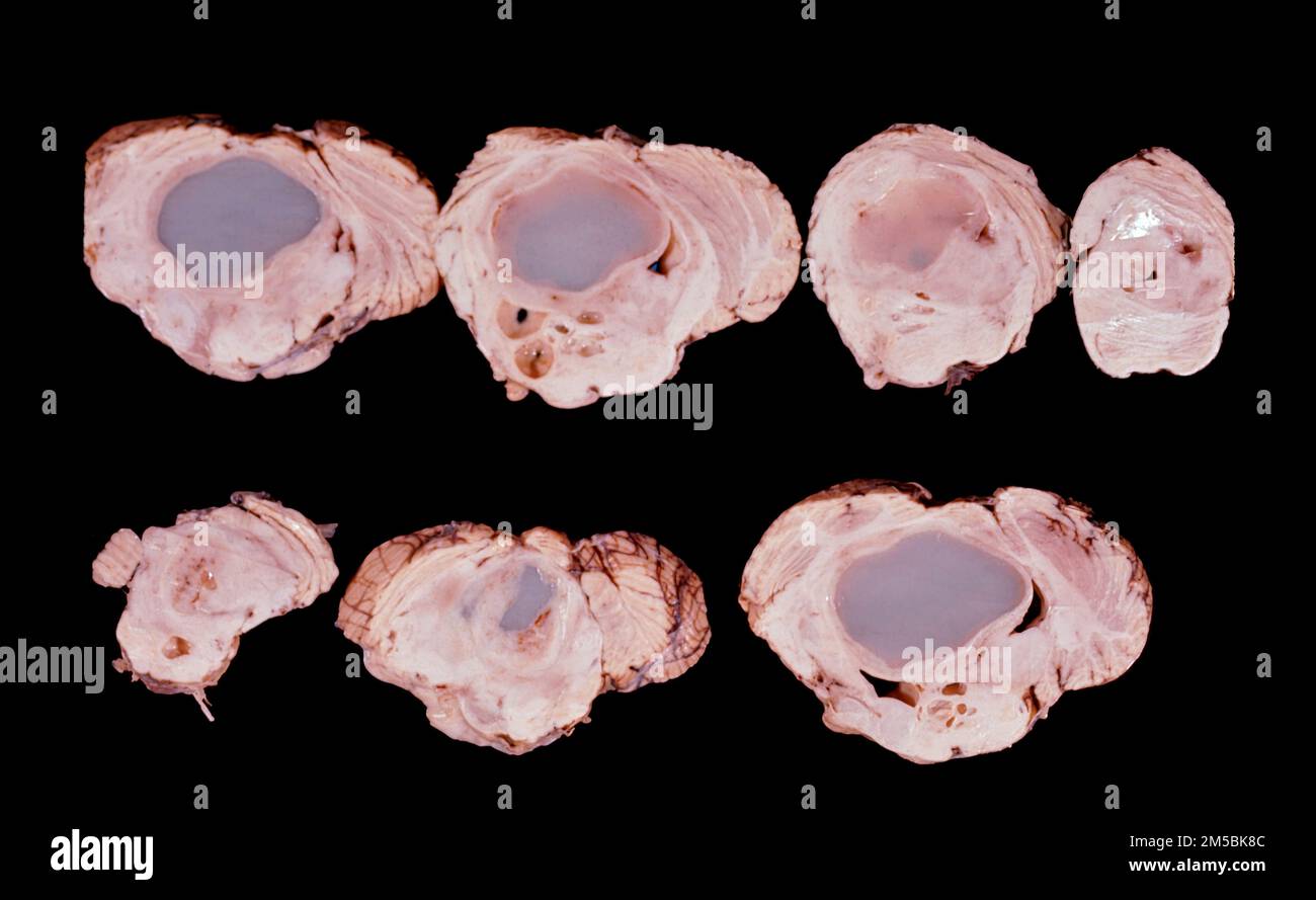Gross specimen showing the extension of a pilocytic astrocytoma (PA ...