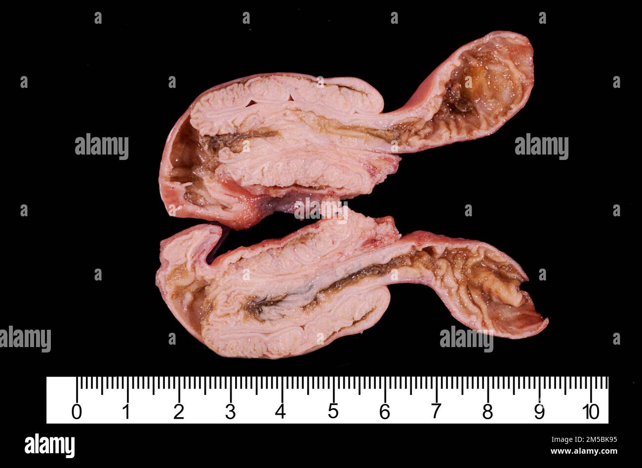 Gross specimen of a human small bowel affected by an intussusception, a ...