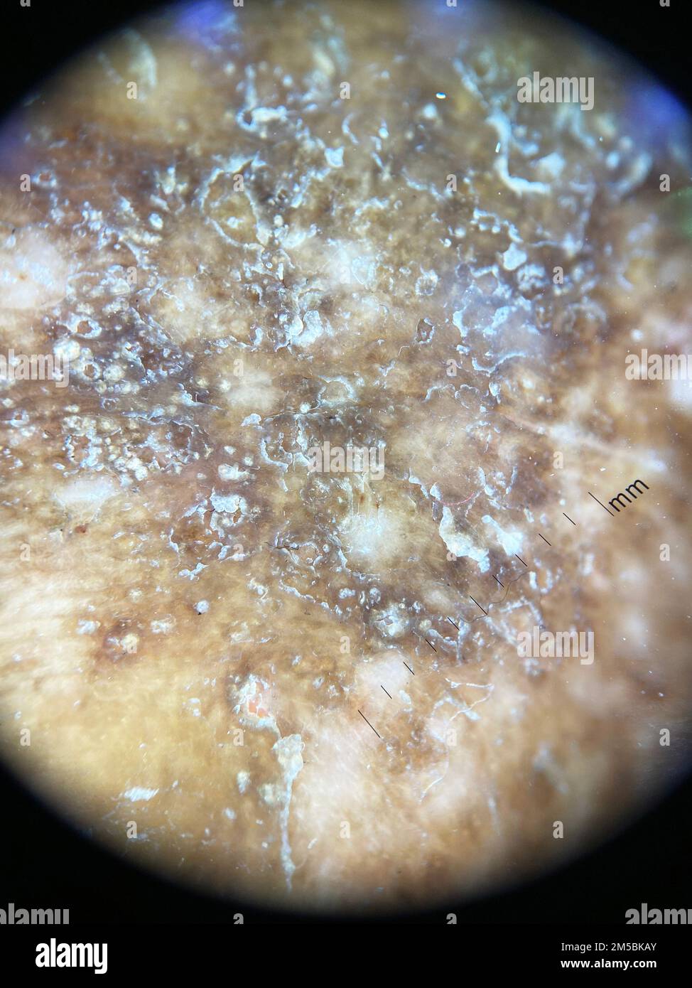 Dermatoscope image of allergic contact dermatitis on the hand of a 50 ...