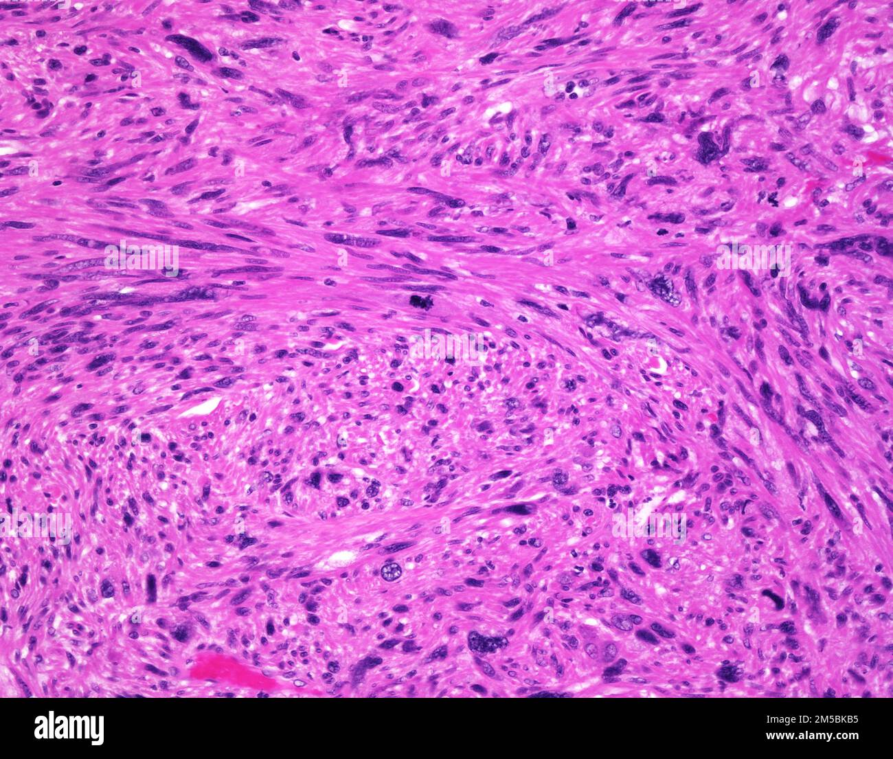 Leiomyosarcoma, light micrograph. Leiomyosarcoma is a malignant tumour ...