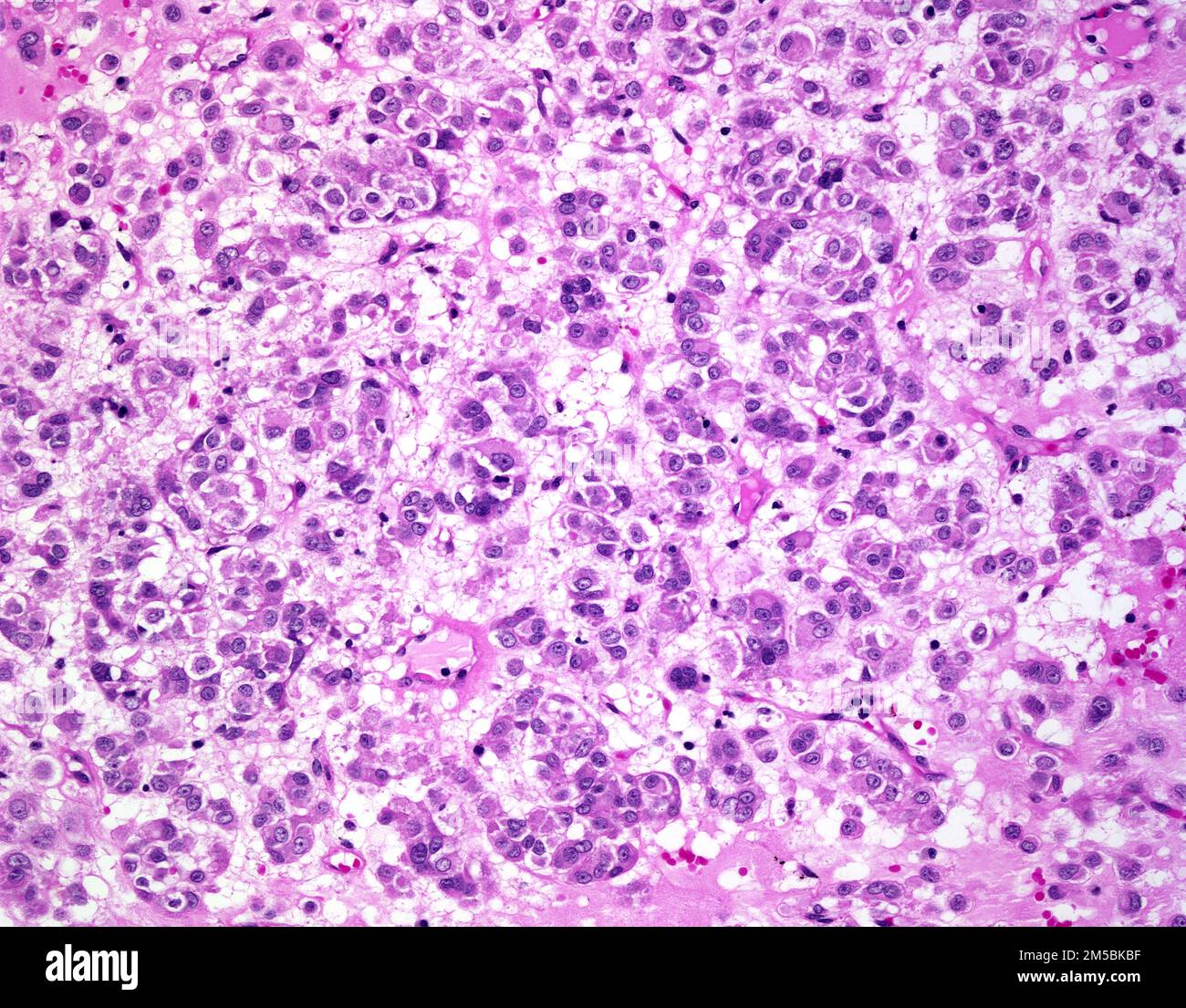 Leiomyosarcoma, light micrograph. Leiomyosarcoma is a malignant tumour ...