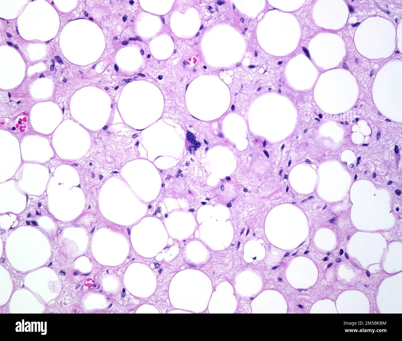 Well-differentiated liposarcoma, light micrograph. Liposarcoma is one ...