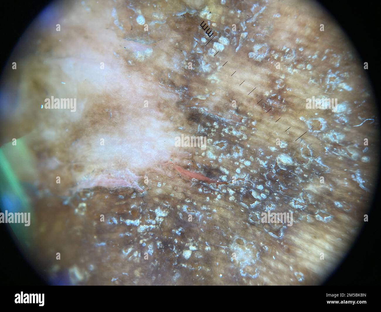 Dermatoscope image of allergic contact dermatitis on the hand of a 50 ...