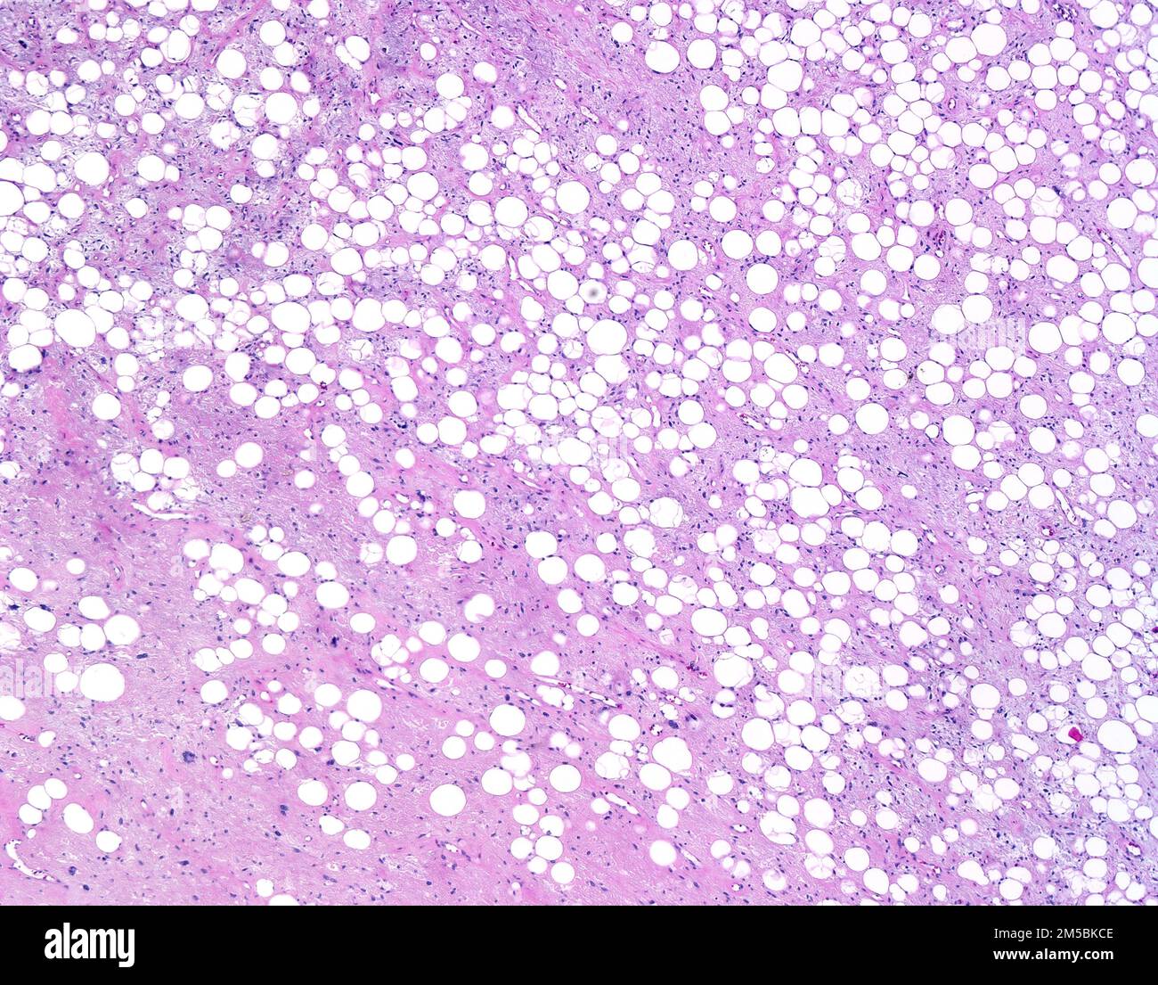 Well-differentiated liposarcoma, light micrograph. Liposarcoma is one ...