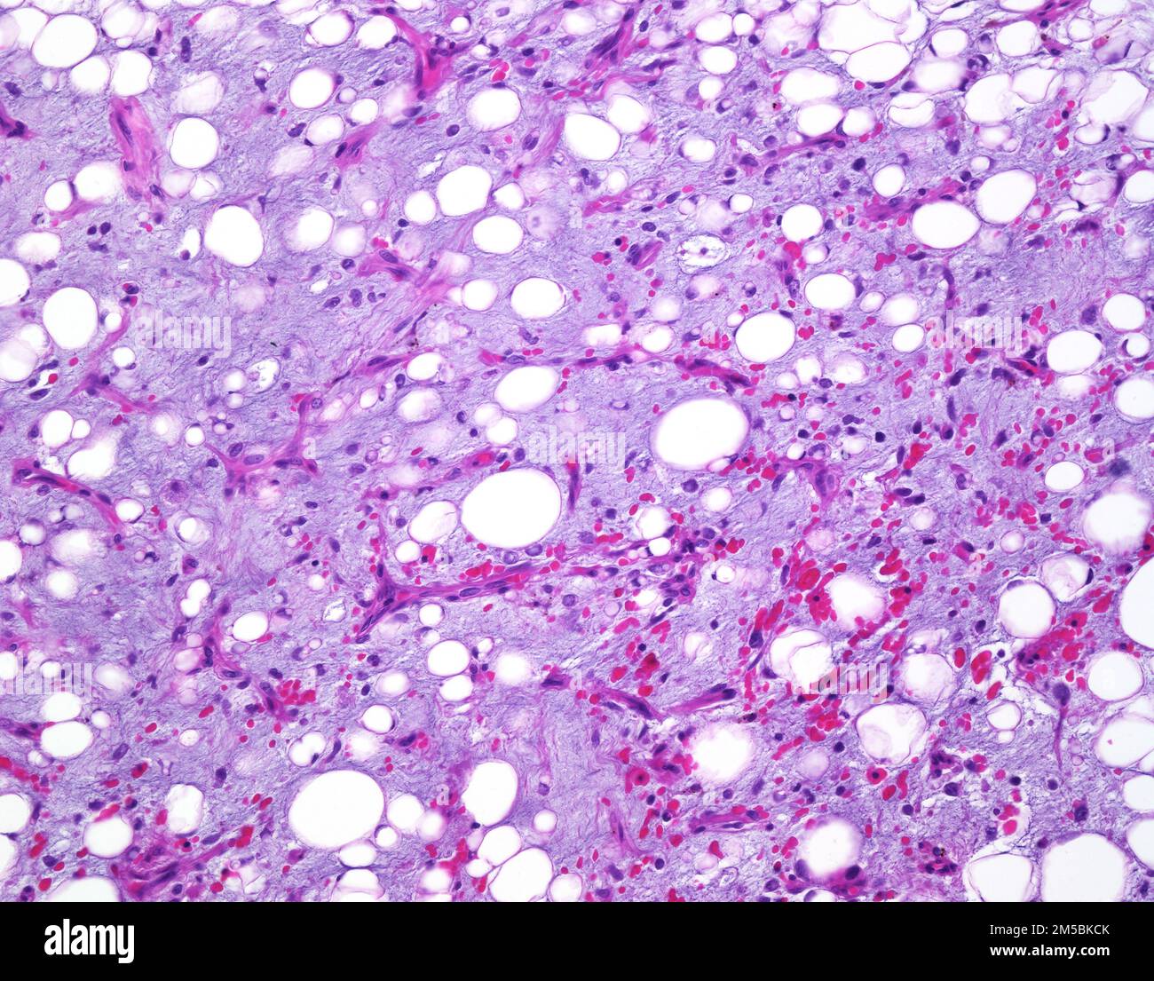 Liposarcoma, light micrograph. Liposarcoma is one of the most common sarcomas of adulthood. It ...