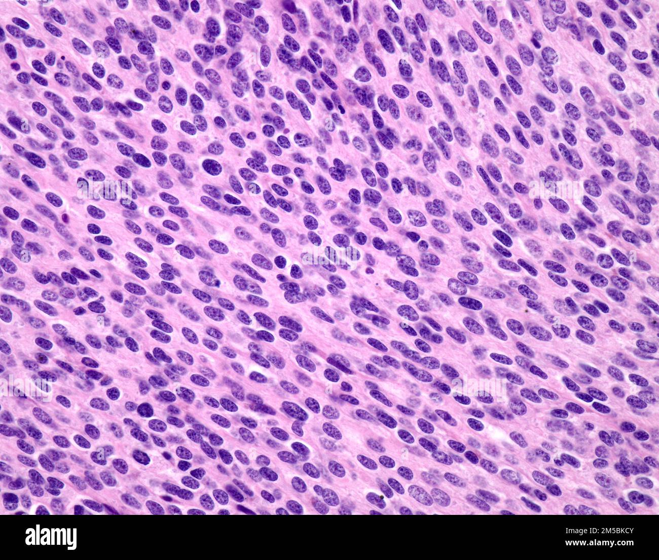 Malignant peripheral nerve sheath tumour, light micrograph. Malignant ...