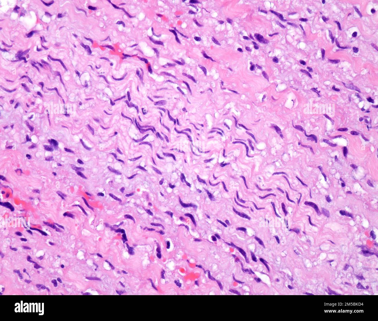 Malignant peripheral nerve sheath tumour, light micrograph. Malignant ...