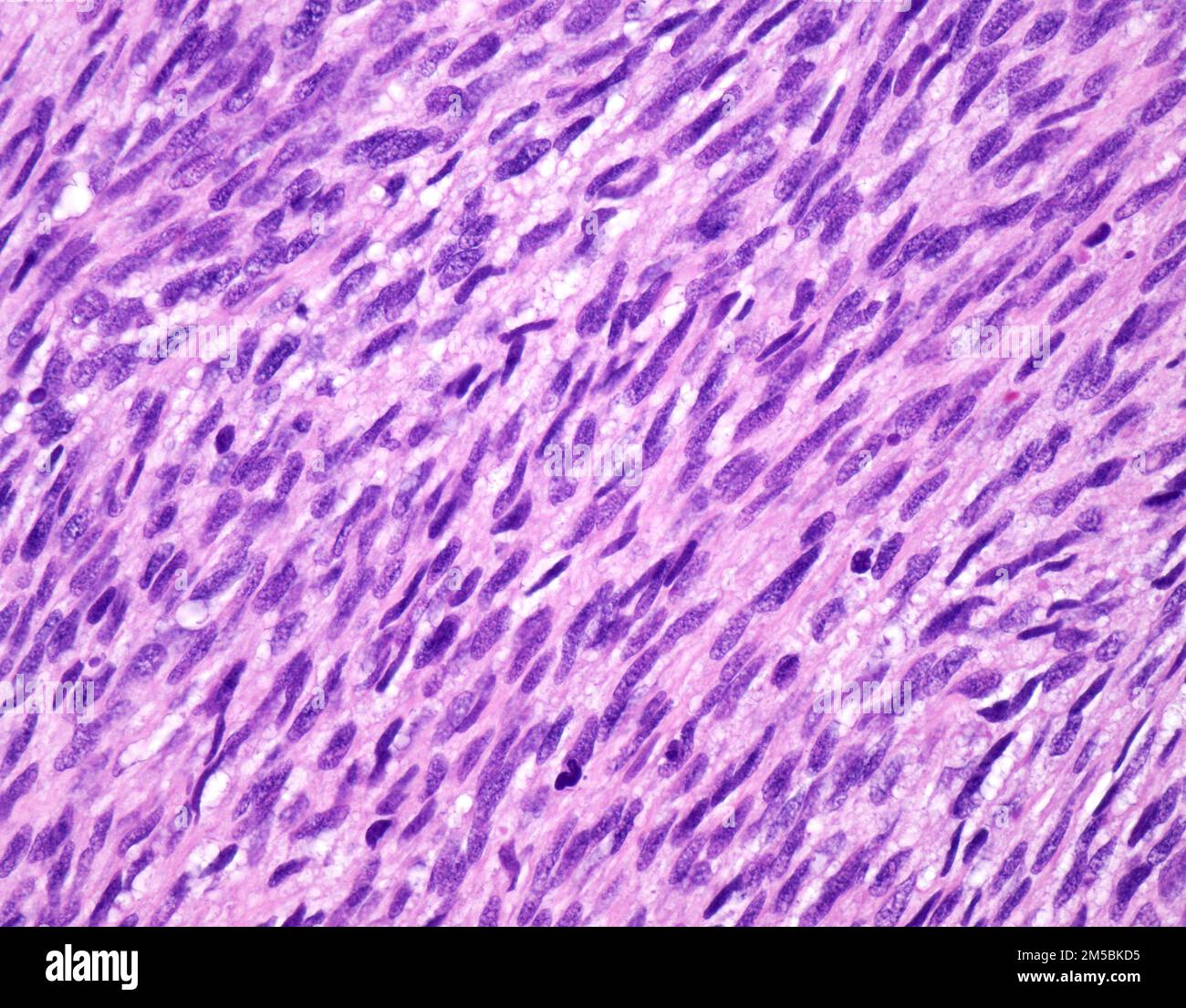 Malignant peripheral nerve sheath tumour, light micrograph. Malignant ...