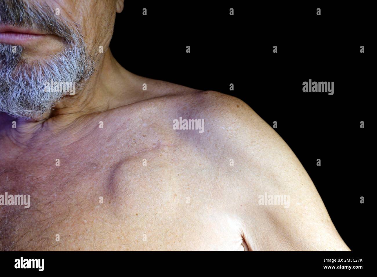 Elderly man with a pacemaker, studio photography with black background ...