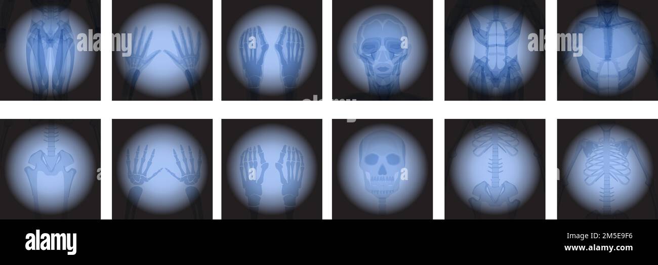 Shoulder bones x rays Stock Vector Images - Alamy