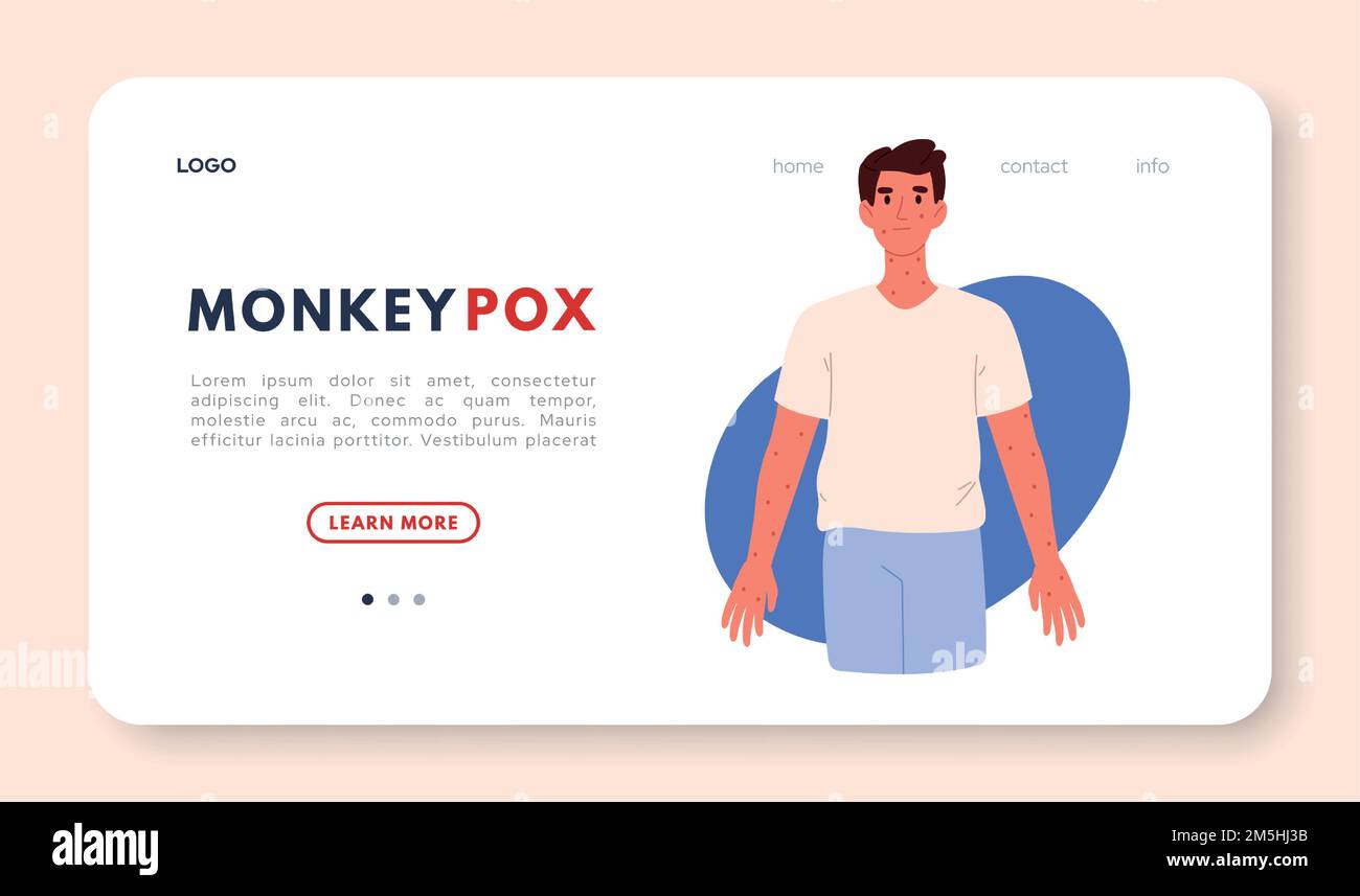 Monkeypox virus symptoms landing page. Website template of Monkeypox ...