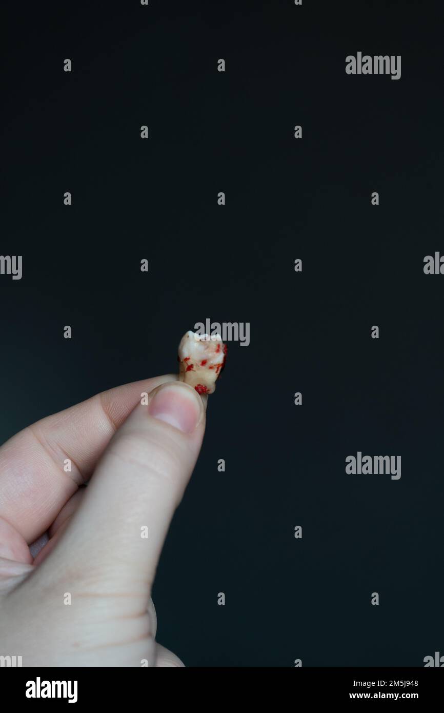 A woman's hand holds a wisdom tooth. The concept of dentistry, tooth ...