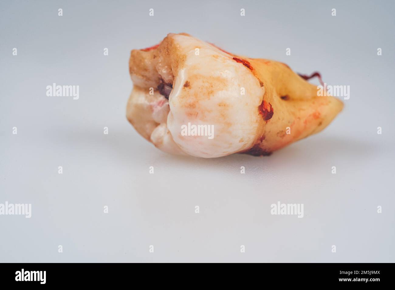 Human wisdom tooth isolated on gray background. Dentistry concept ...
