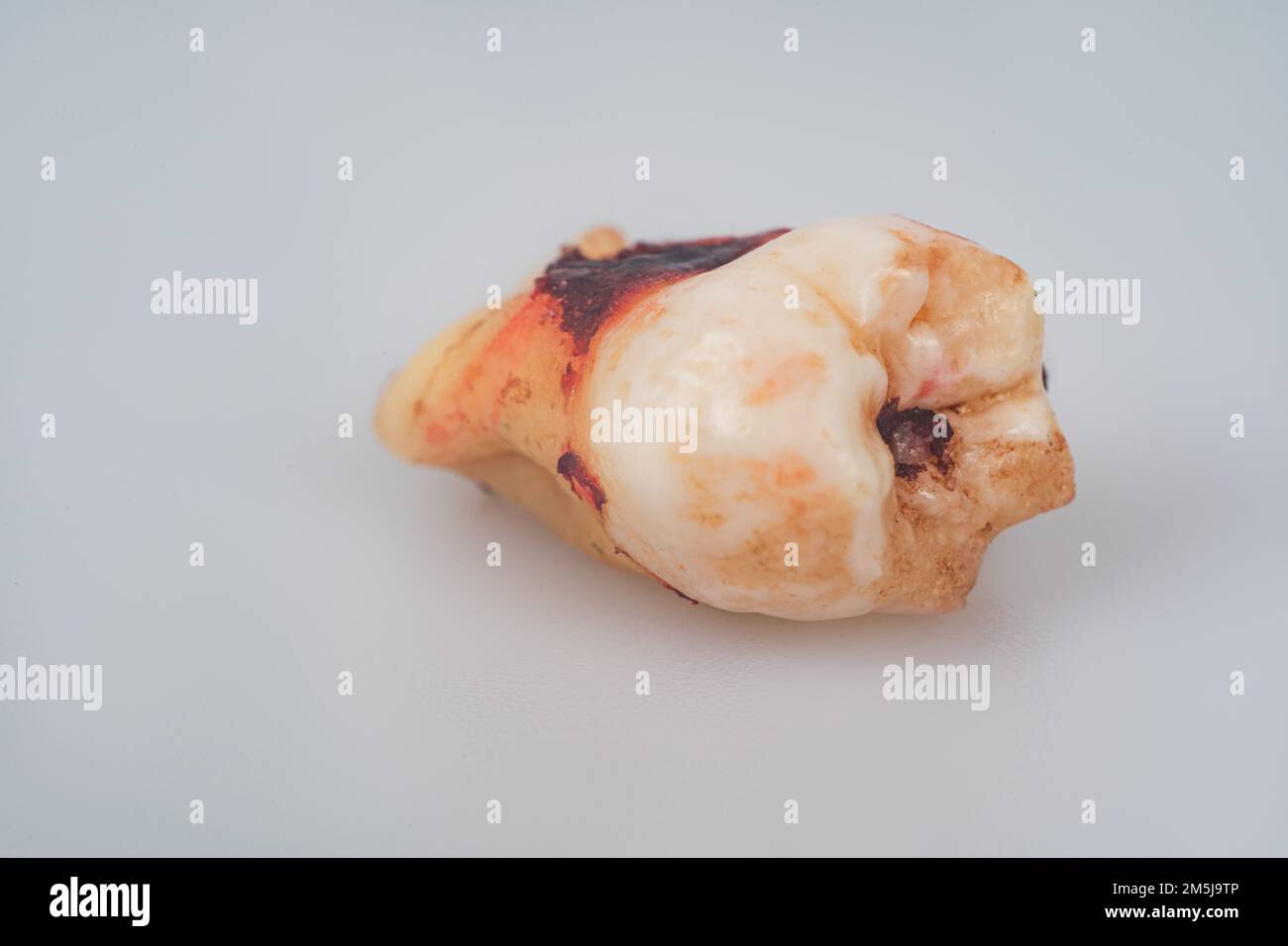 Human wisdom tooth isolated on gray background. Dentistry concept ...