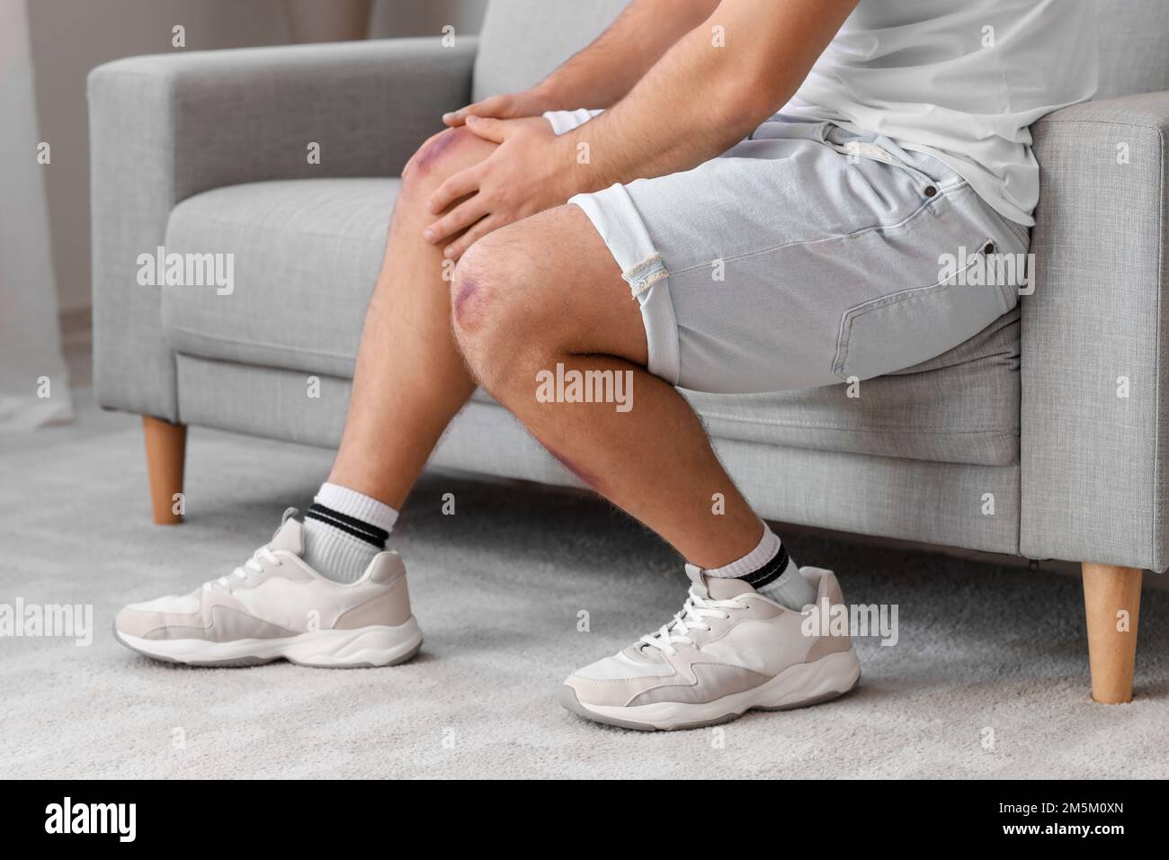 Bruise bruises bruised knee hi-res stock photography and images - Alamy