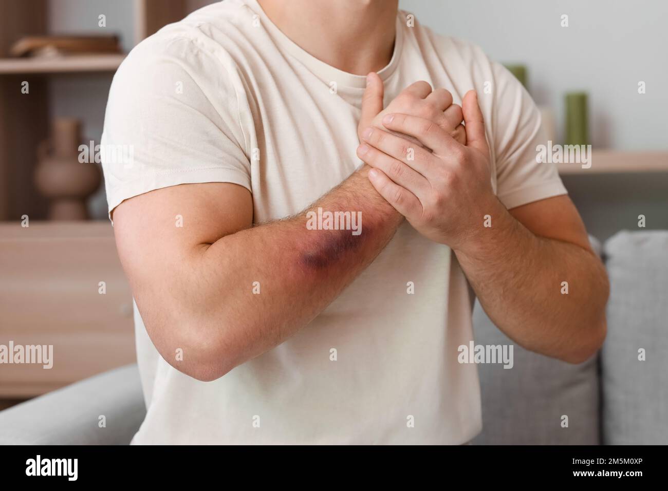 Man with bruises on his arm at home Stock Photo - Alamy