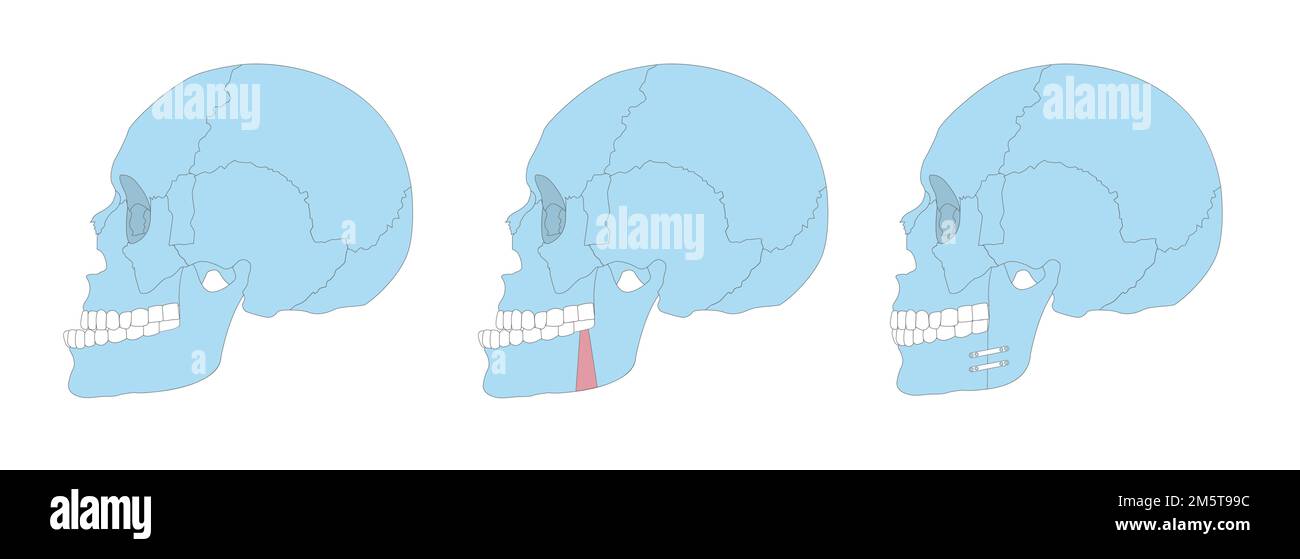 Overbite teeth Stock Vector Images - Alamy