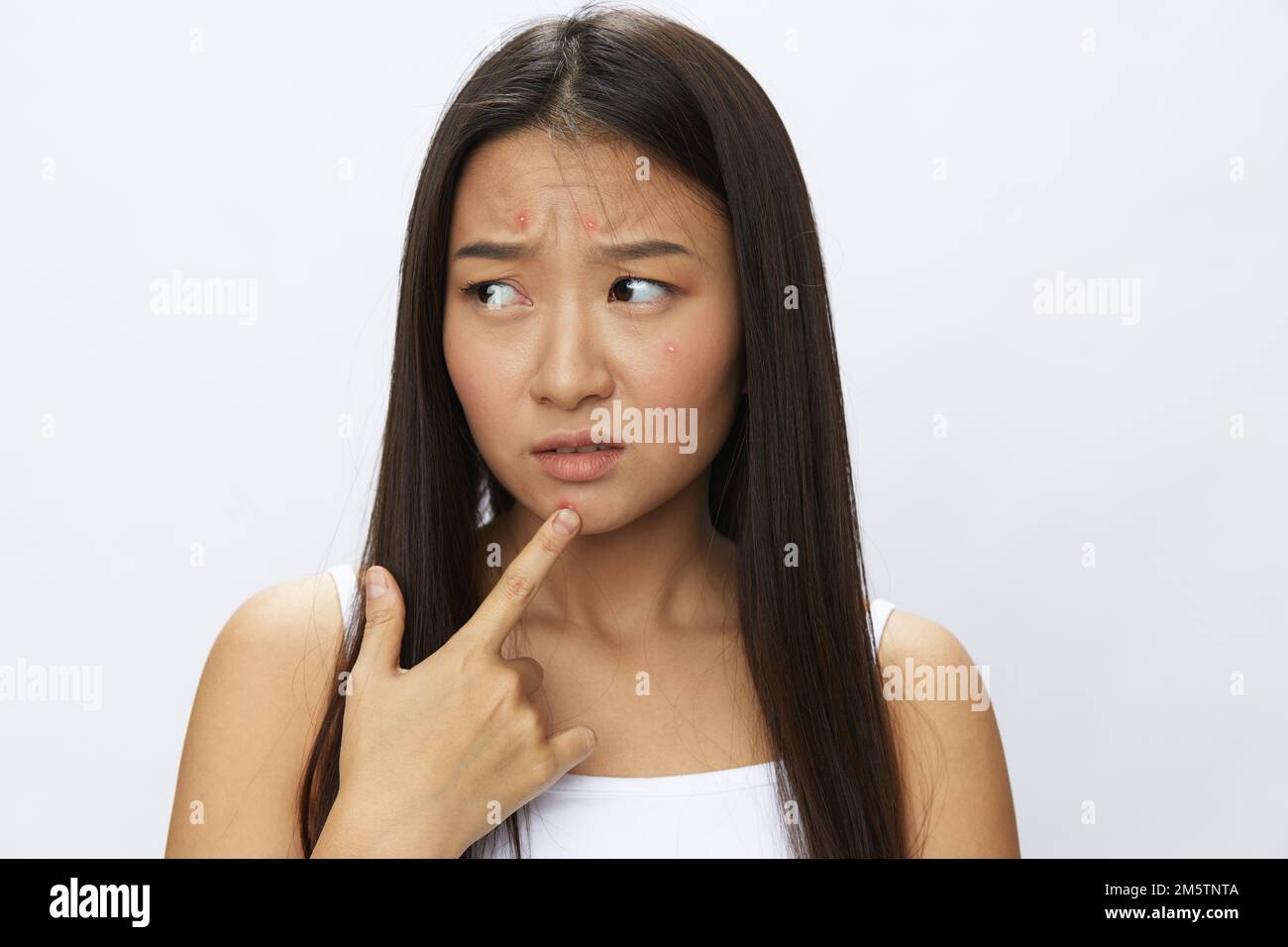 Asian woman facial skin problems, acne and inflammation, red rashes and ...