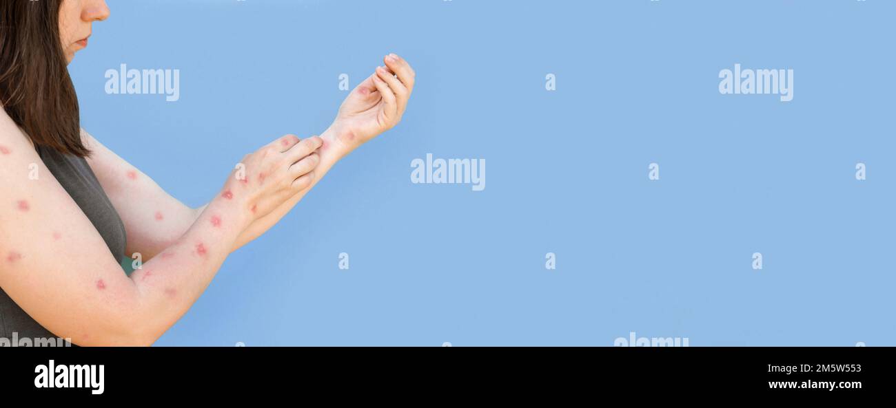 Monkeypox new disease dangerous over the world. Patient with Monkey Pox ...