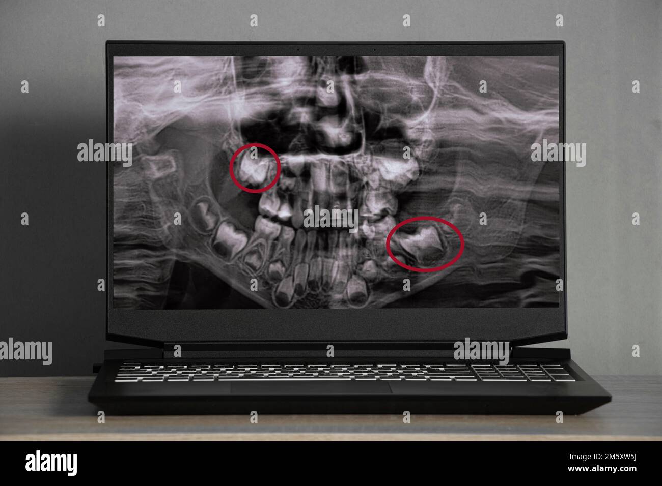 panoramic X-ray of children's teeth of two jaws, orthopantomogram of ...