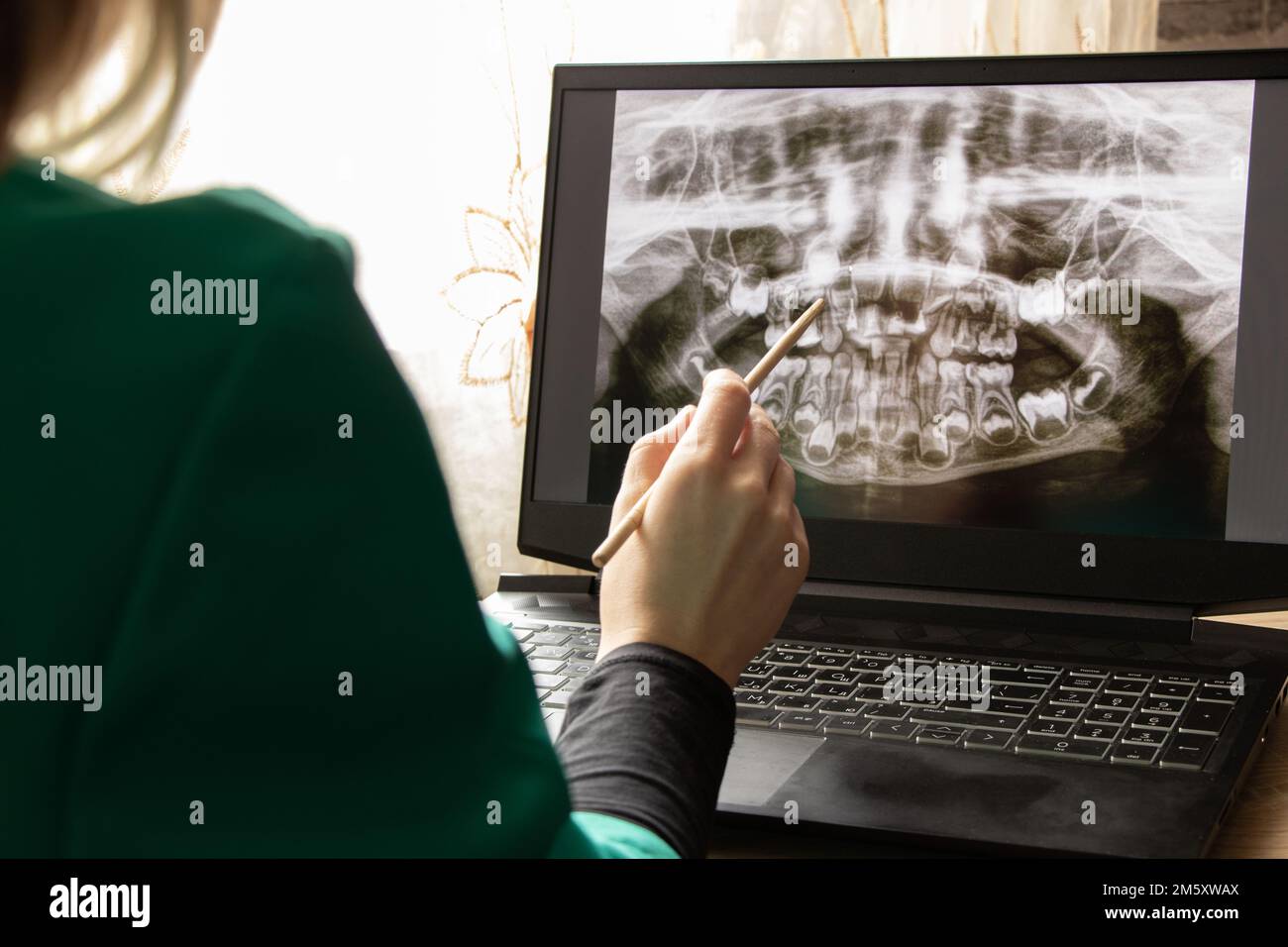 panoramic X-ray of children's teeth of two jaws, orthopantomogram of ...