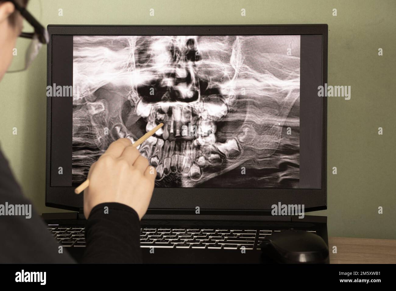 panoramic X-ray of children's teeth of two jaws, orthopantomogram of ...