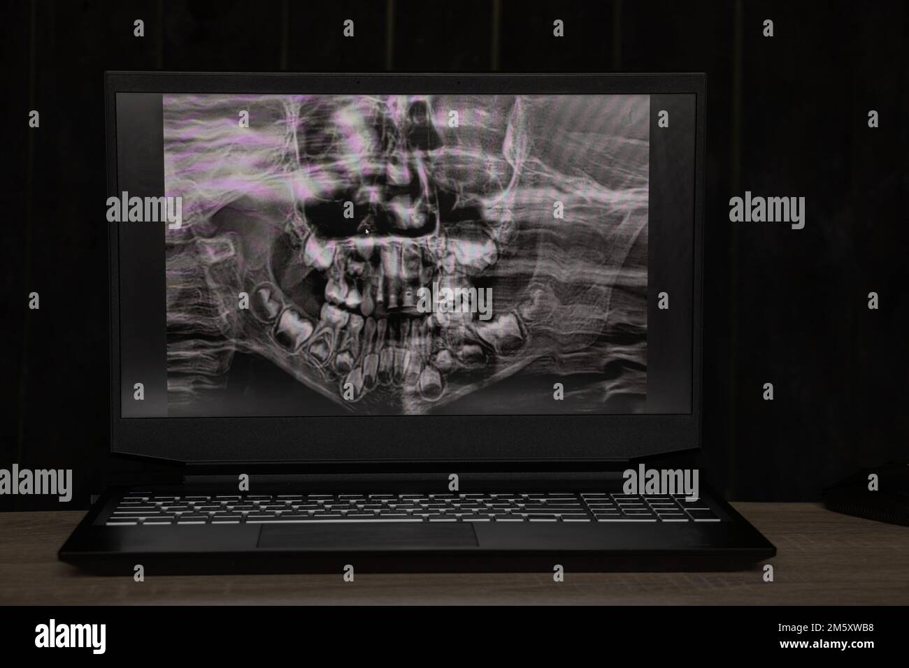 panoramic X-ray of children's teeth of two jaws, orthopantomogram of ...