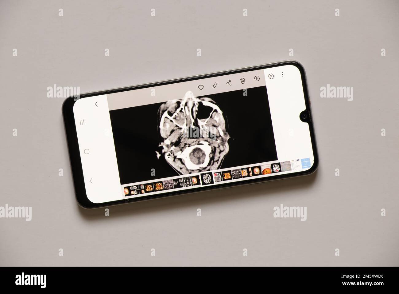 3D computed tomography of the brain with a fracture of the frontal part ...