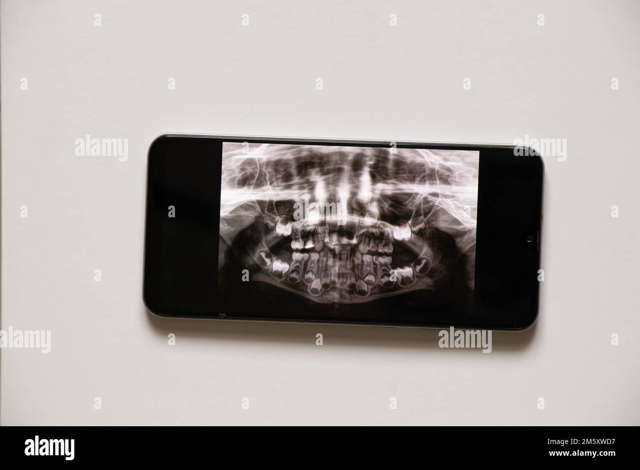 Panoramic shot shows several embedded and impacted teeth on both the ...