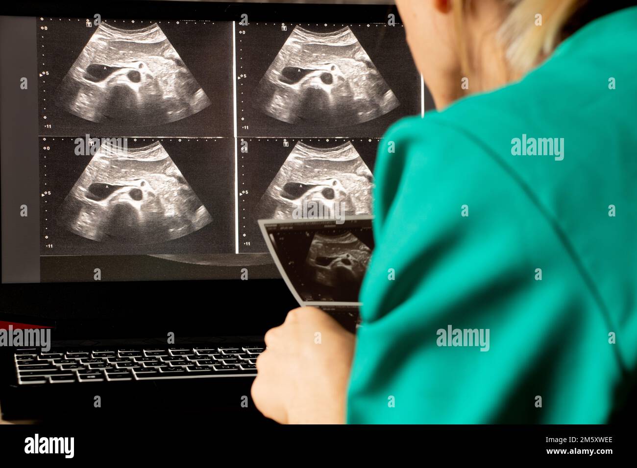 Ultrasound of a woman's abdomen on a laptop screen monitor in a doctor ...