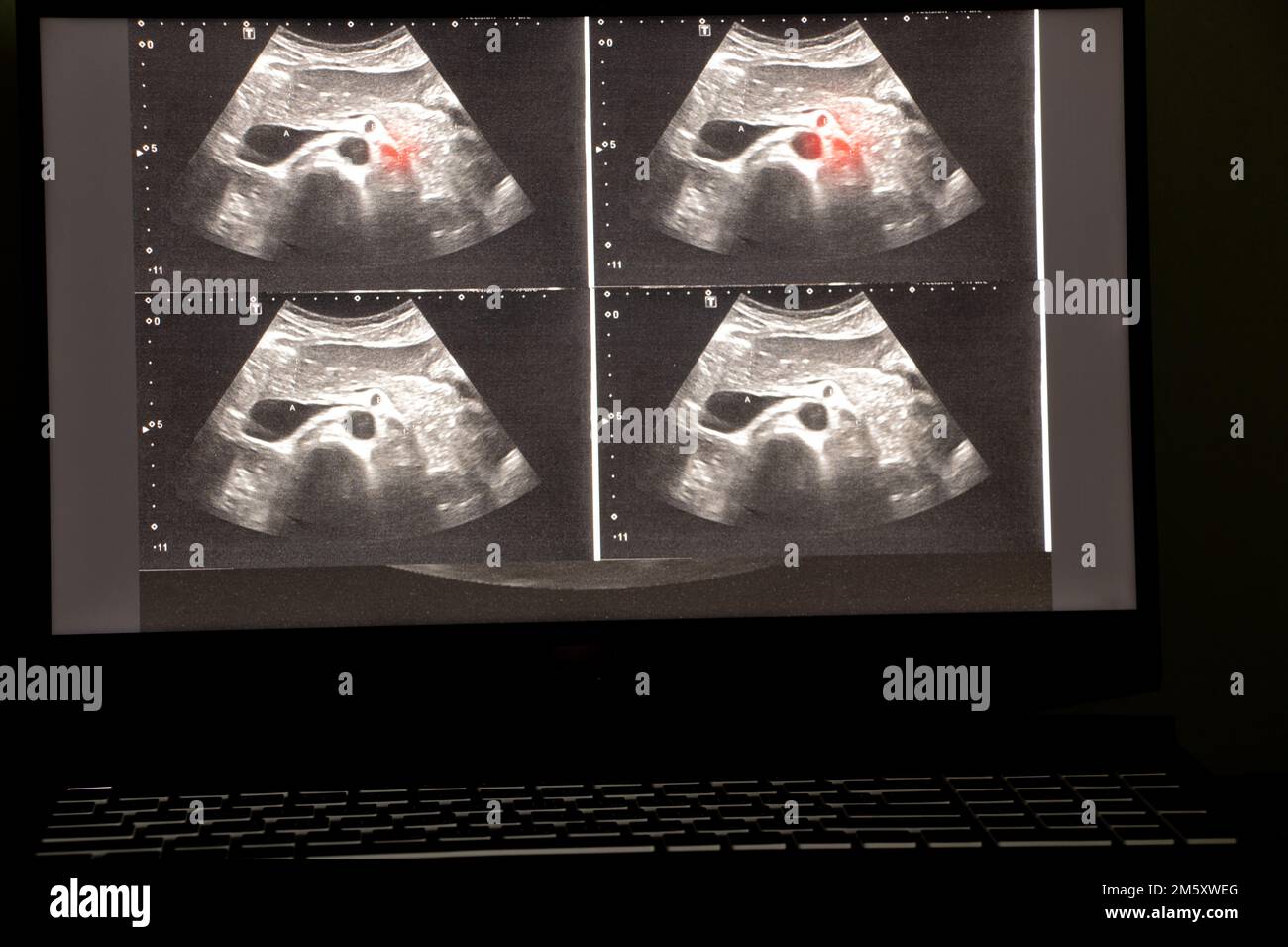 Ultrasound of a woman's abdomen on a laptop screen monitor in a doctor ...