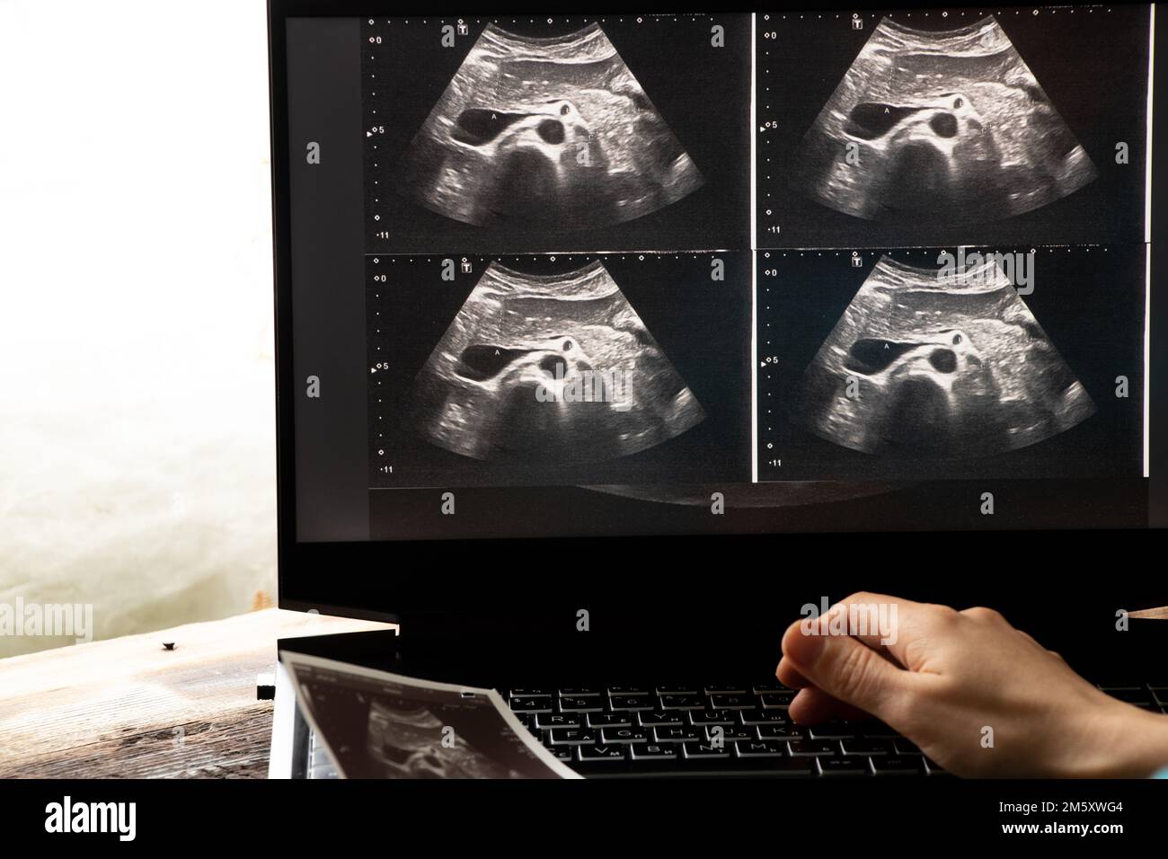 Ultrasound of a woman's abdomen on a laptop screen monitor in a doctor ...