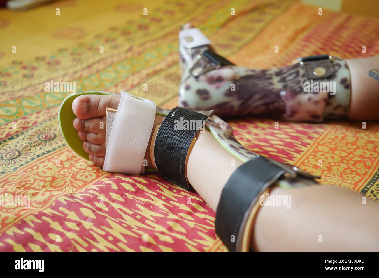 Child cerebral palsy disability, legs orthosis Stock Photo - Alamy