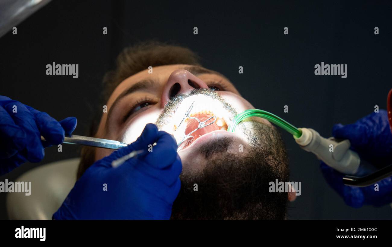 Tooth decay prevention. man in the dentist chair during a dental ...