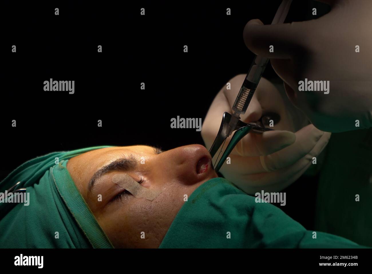 rhinoplasty surgery, defects in the shape of the nose in the female ...