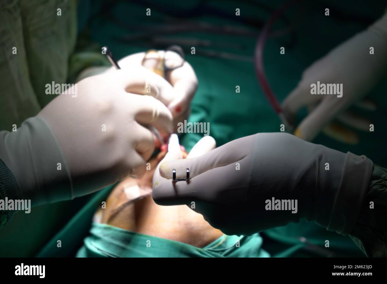 rhinoplasty surgery, defects in the shape of the nose in the female ...