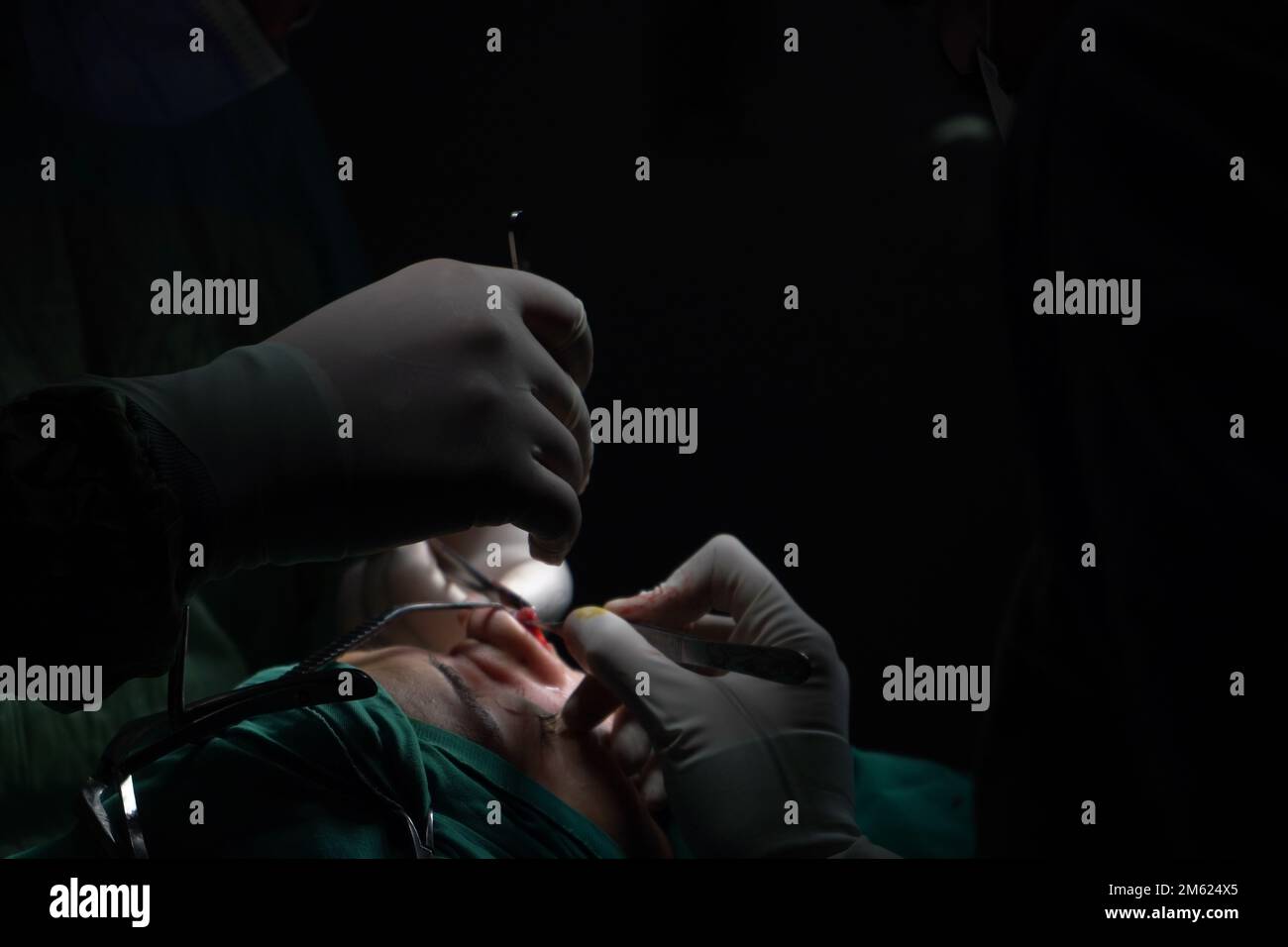 rhinoplasty surgery, defects in the shape of the nose in the female ...