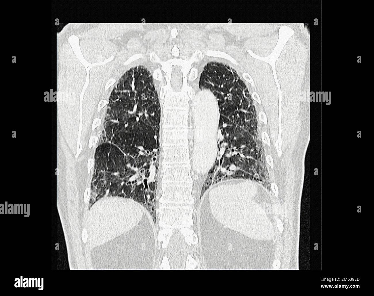 Lung tissue with pneumonia hi-res stock photography and images - Alamy