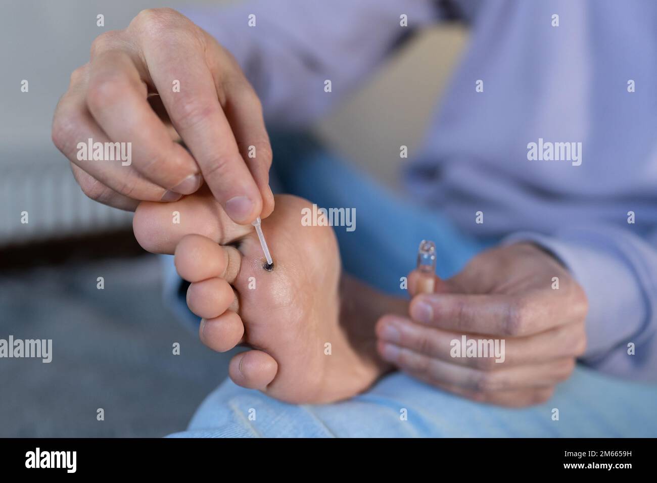 Alternative home treatment of verruca foot. Man applying liquid ...