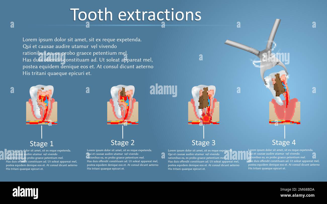 Tooth extraction concept vector poster banner template Stock Vector ...
